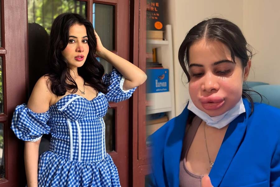 Uorfi Javed: होठों ने बिगाड़ा चेहरे का नक्शा, लिप फिलर्स करवाना पड़ा भारी