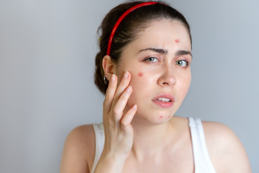 Pimple Treatment: पिंपल्स और उन के दाग दूर करने का कोई उपाय बताएं?